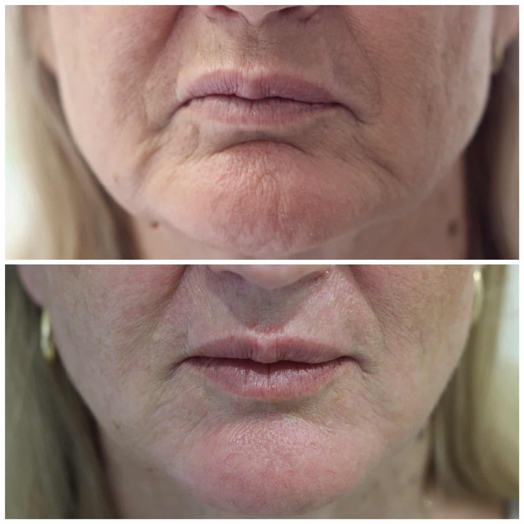 Why 3 ml of filler is better than 1 ml | Envisage Clinic | Dr Chris Leat